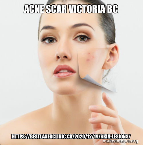 Acne Scar Victoria BC https://bestlaserclinic.ca/2020/12/19/skin ...