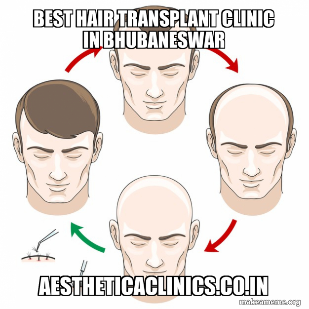 Best Hair Transplant Clinic in Bhubaneswar aestheticaclinics.co.in Meme ...