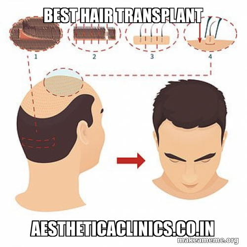 Best Hair Transplant aestheticaclinics.co.in Meme Generator