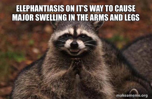 Elephantiasis On It's Way To Cause Major Swelling In The arms and legs ...