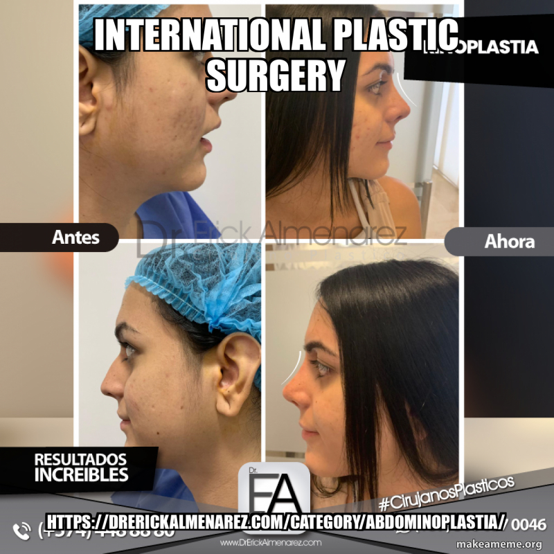International plastic surgery https://drerickalmenarez.com/category ...