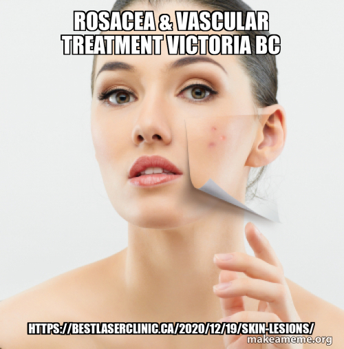 Rosacea Memes